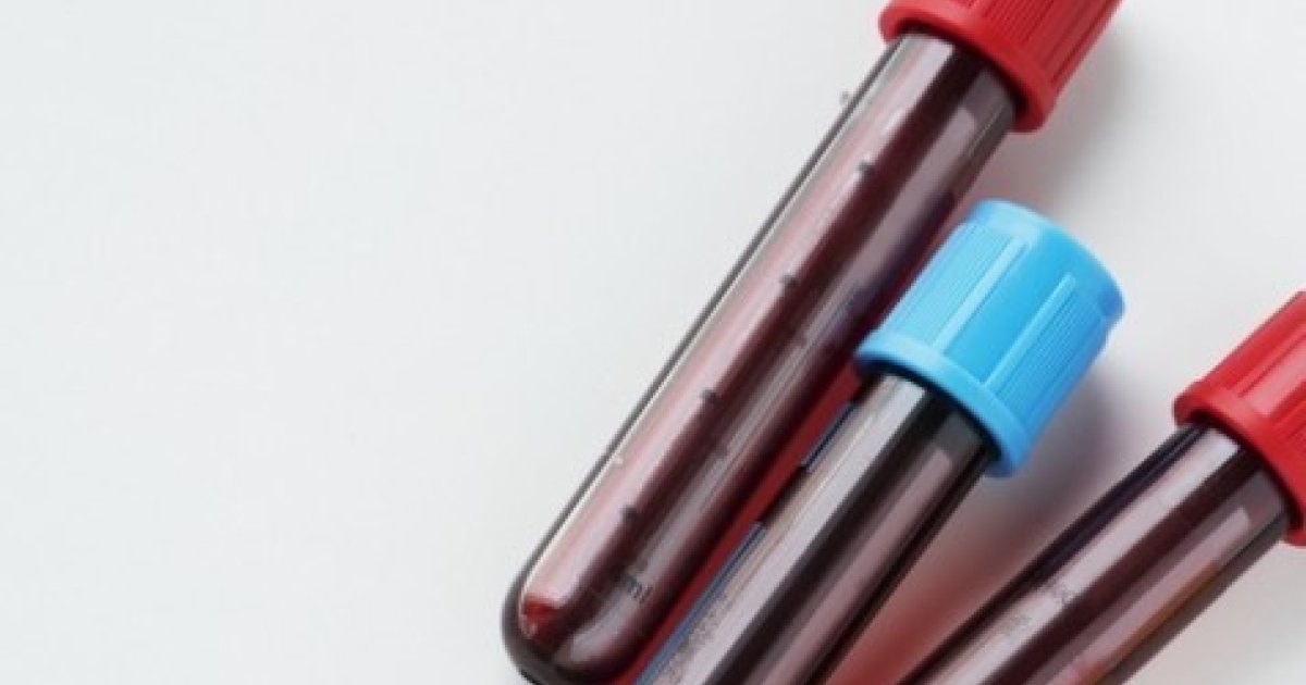 Exagen Diagnostics and CareFirst Team Up to Study AVISE Lupus Test ...