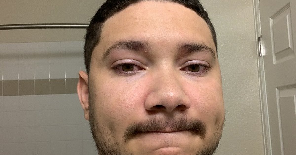 Joshua W. - Diagnosed at age 24 | Lupus Foundation of America